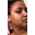 Perrigo Body Wash with 5% Benzoyl Peroxide, 142g Liquid - Walmart.com