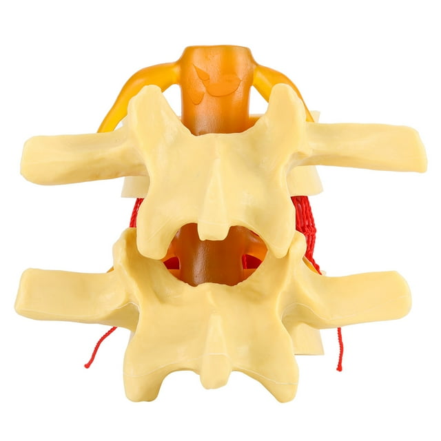 1:1.5 Anatomical Medical Human Spine Lumbar Disc Herniation ...