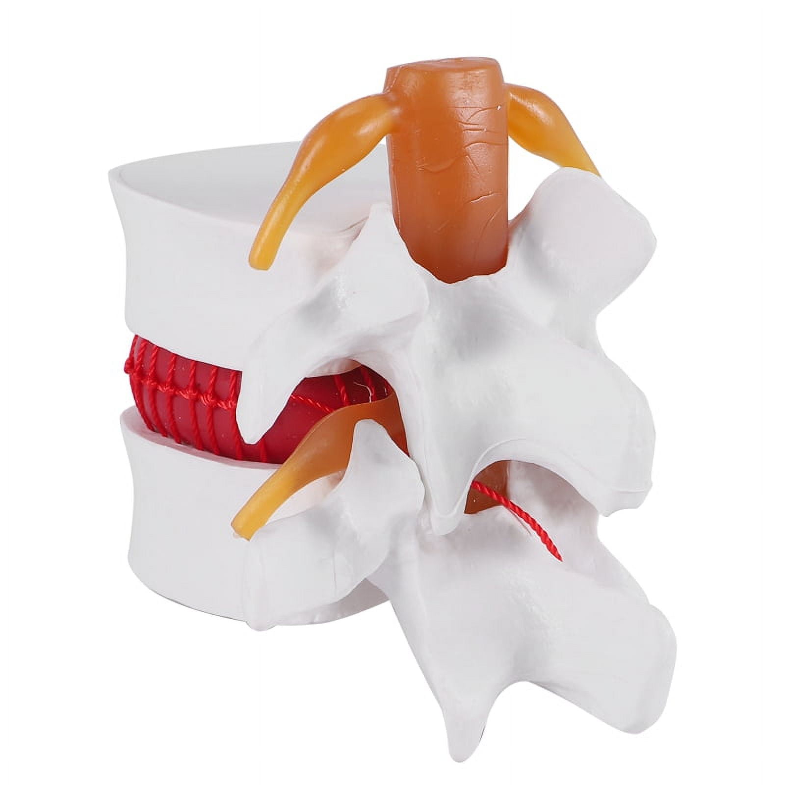 1:1.5 Human Lumbar Disc Herniation Demonstration Model of Lumbar ...
