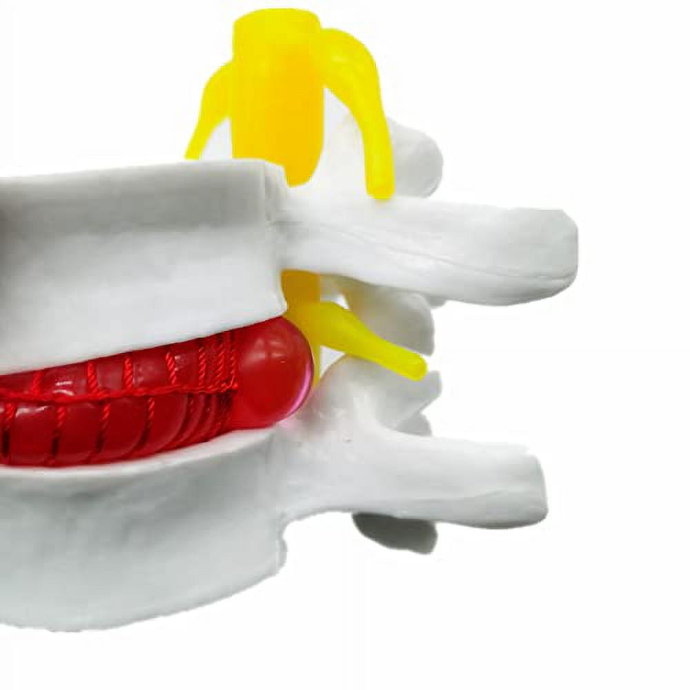 1 PCS Human Lumbar Disc Herniation Model, Anatomical Human Lumbar ...