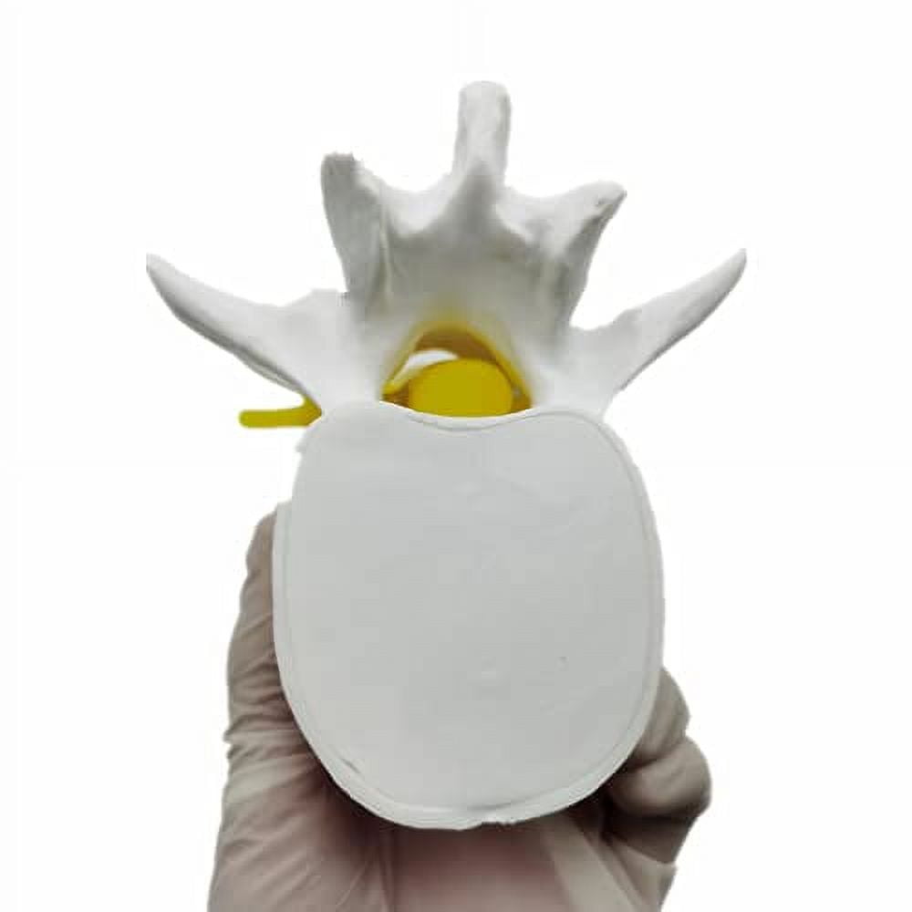 1 PCS Human Lumbar Disc Herniation Model, Anatomical Human Lumbar ...