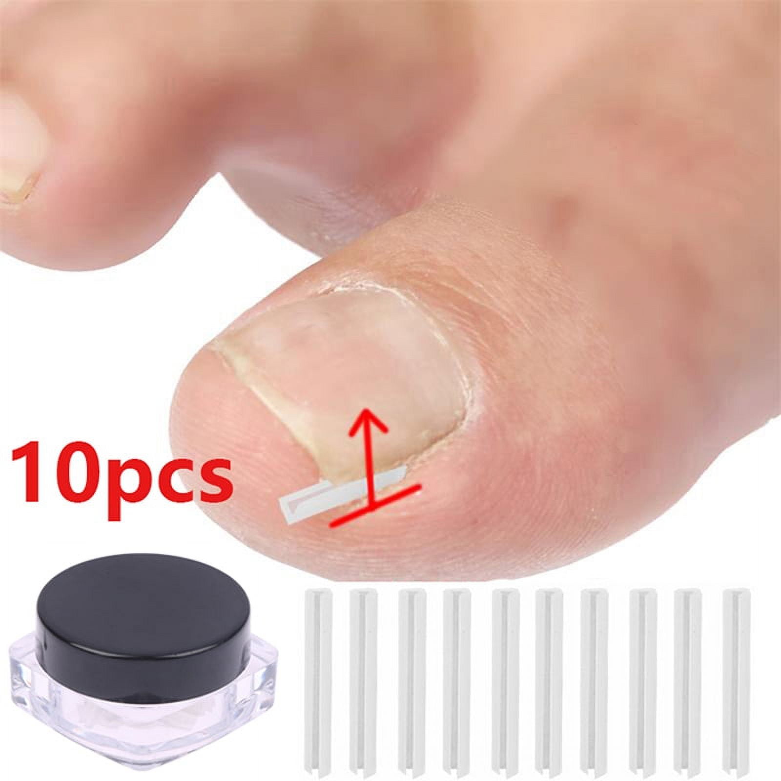 10PcsPcs Nail Correction Stickers Ingrown Toenail Corrector Patches ...