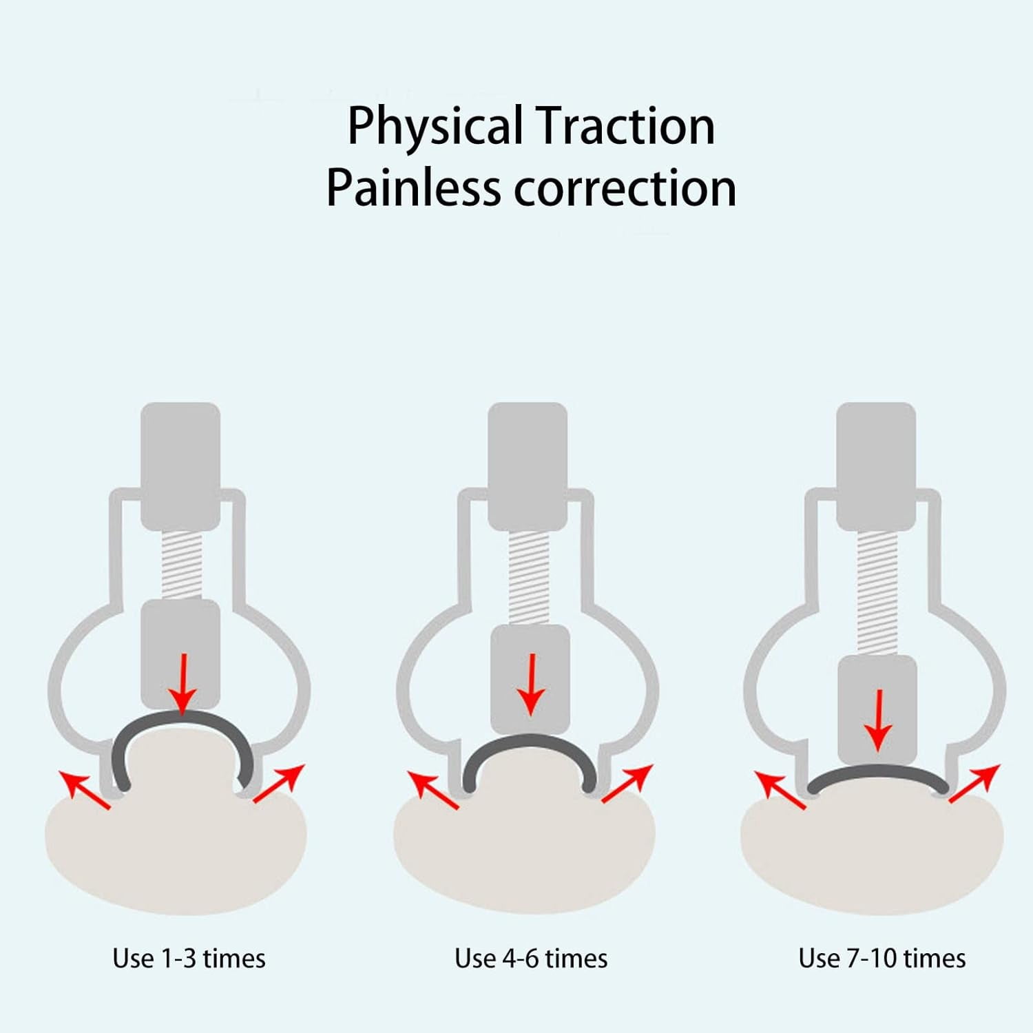 1Pack Ingrown Toenail Lifter Foot Care Tool, Toenail Clamp Stainless ...