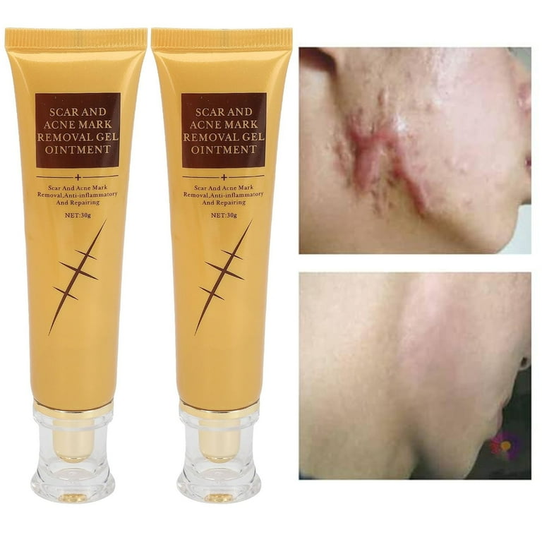 2 Pack Scar Removal Cream Acne Scar Treatment Scar Cream for Surgical Scars Acne Skin Care Cream Acne Treatment Cream for Scars Burns Stretch Marks Acne Spots Walmart