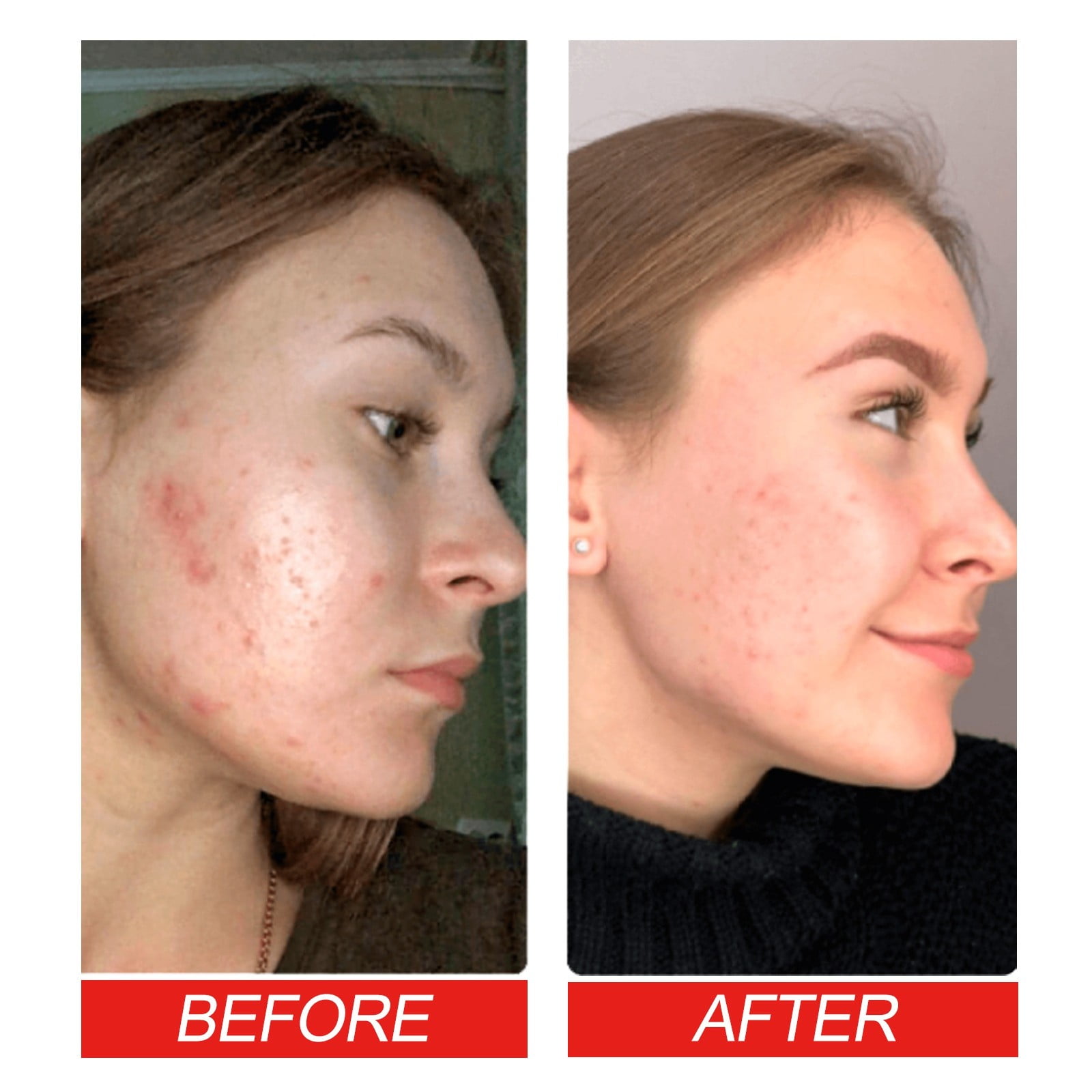 200pcs Patch Clean Close Mouth Gently Reduce Skin Patch Soothing Skin ...