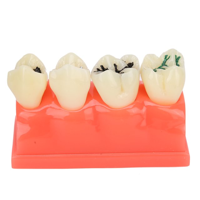 2024 Caries Model Studying Demonstration Education Resin Dental Caries ... 2024 Caries Model Studying Demonstration Education Resin Dental Caries ...