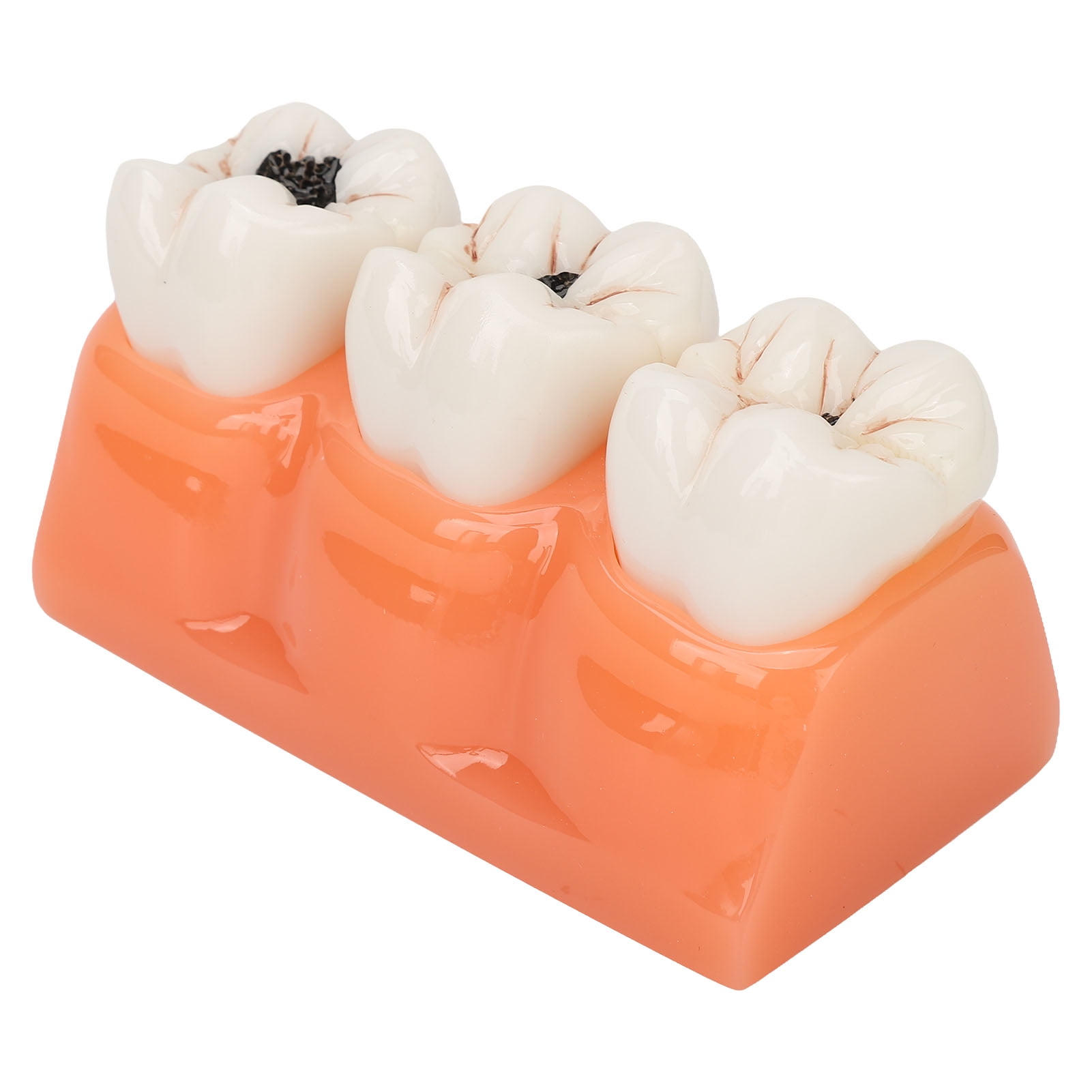 2024 Resin Dental Caries Teeth Model 4 Times Dental Pathology Decayed ... 2024 Resin Dental Caries Teeth Model 4 Times Dental Pathology Decayed ...