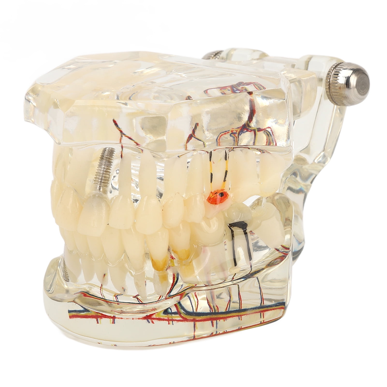 2024 Transparent Dental Implant Pathological Model Implant Disease ...