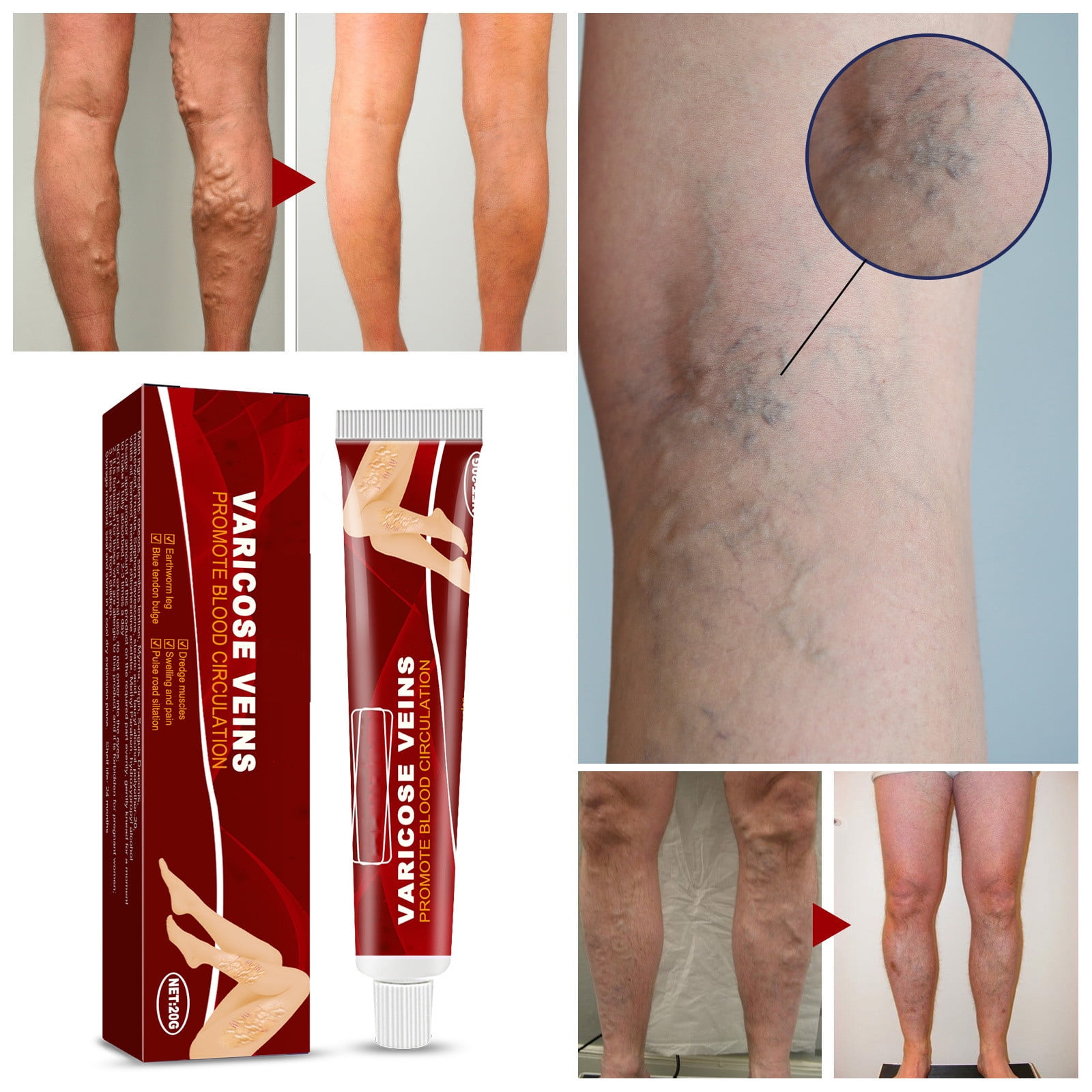 2025 CHOII Varicose Veins Cream,Varicose Veins Paste,Varicose And Spider Veins Ease for Legs ...