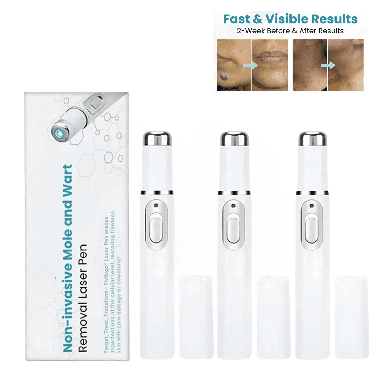 2025 New Non-Invasive Mo*le and Wa*rt Re*mov*al Laser Pen, Advanced ...