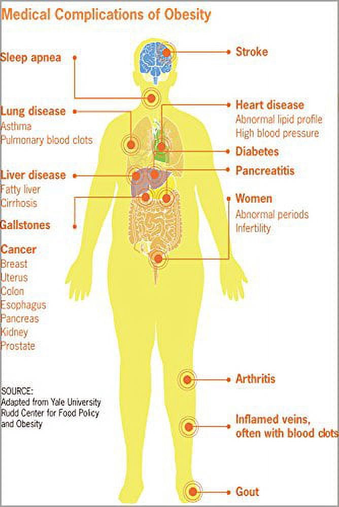 20x30 Poster; Medical Complications Of Obesity And Being Overweight Cdc ...