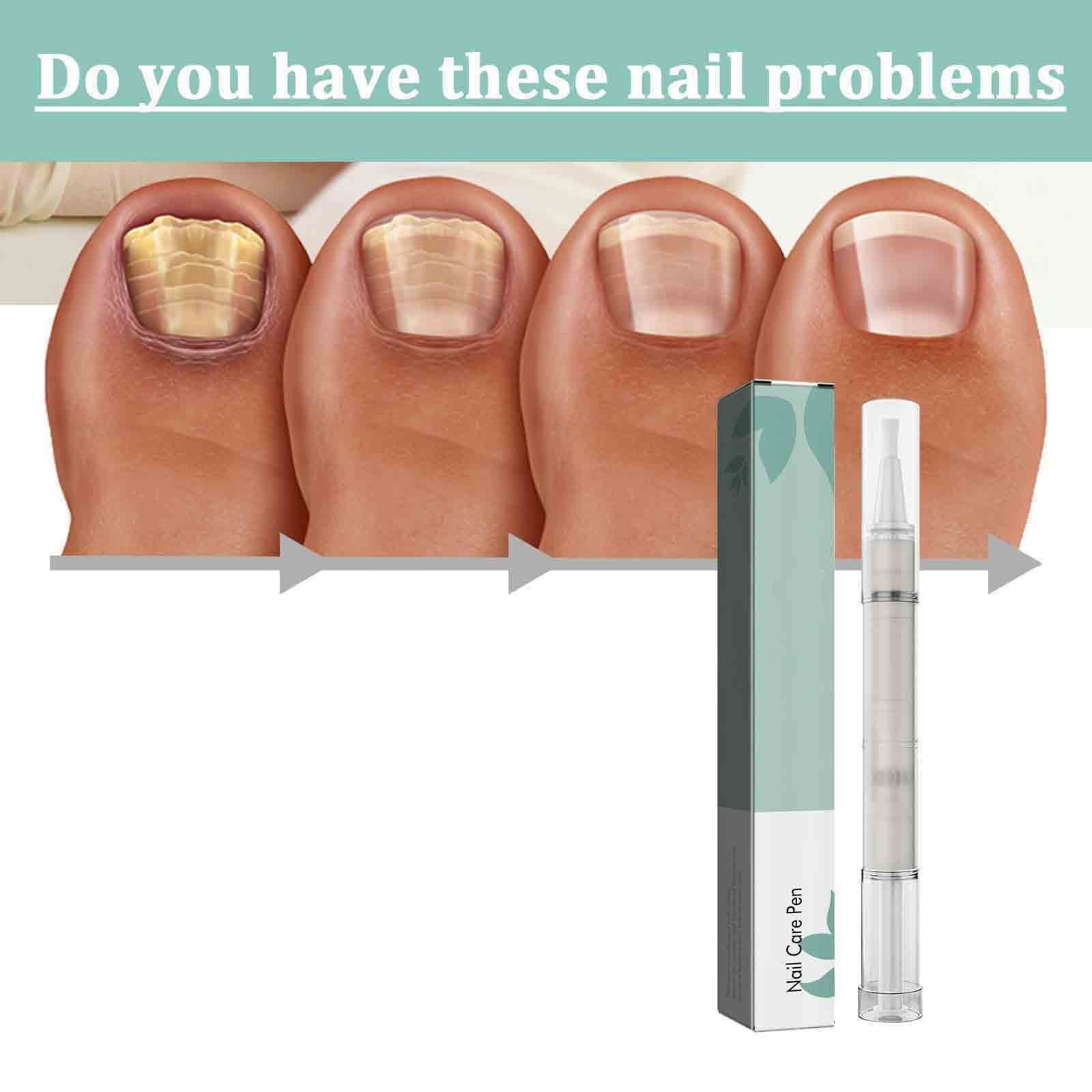 2Pc Nail Pen-4Ml,Nail Health Skin Care,Nail Repair Liquid Cleanser ...