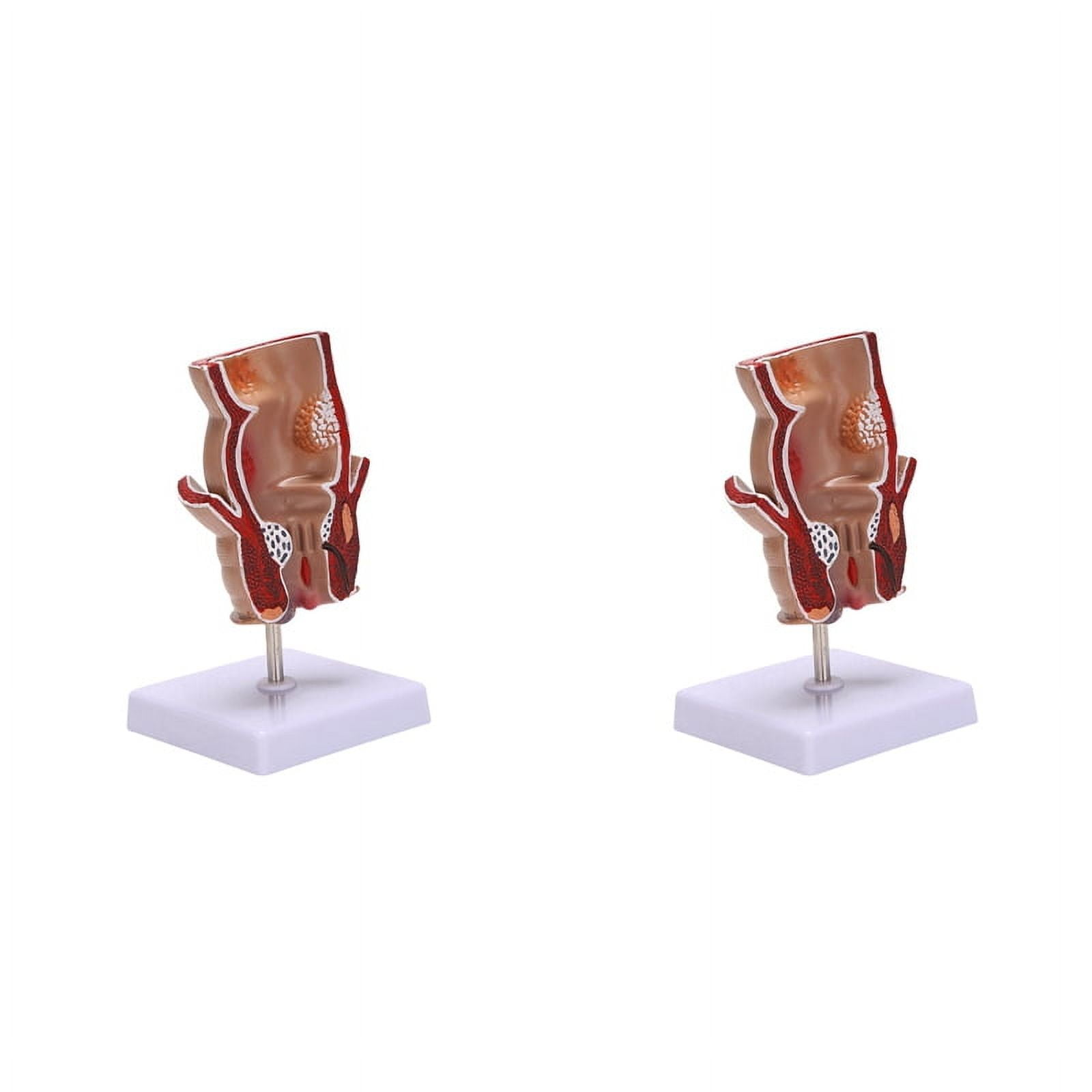 2X Anatomy Model Human Rectal Lesion Model Fistula Fistula Fissure ...
