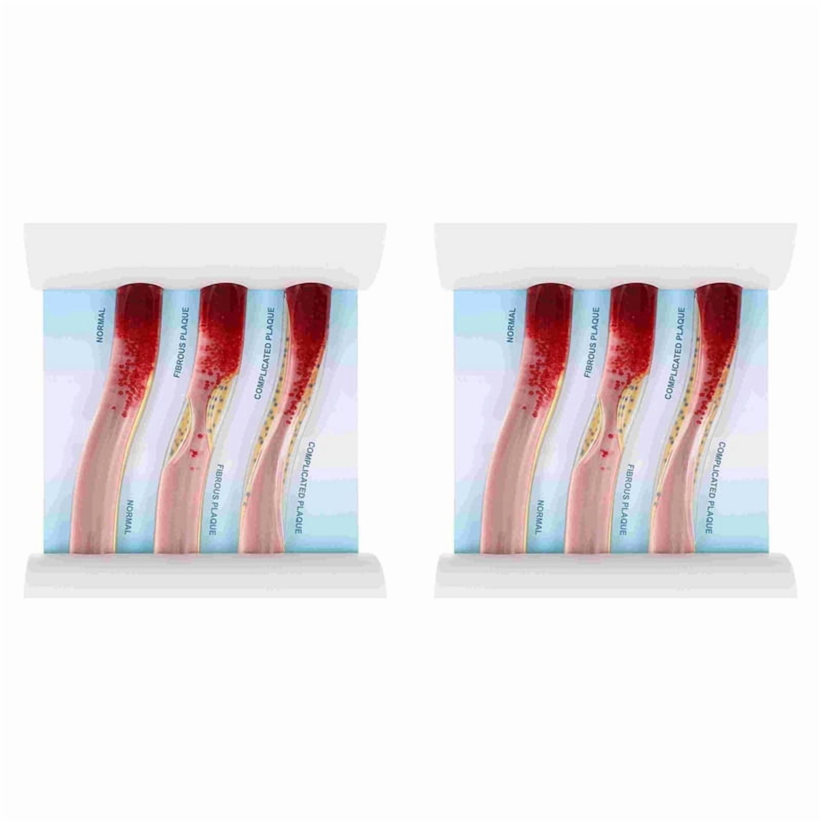 2X Dynamic Blood Vessel Model Cardiovascular Blockage Contrast Model ...