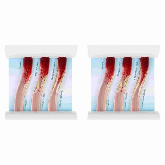 2X Dynamic Blood Vessel Model Cardiovascular Blockage Contrast Model ...
