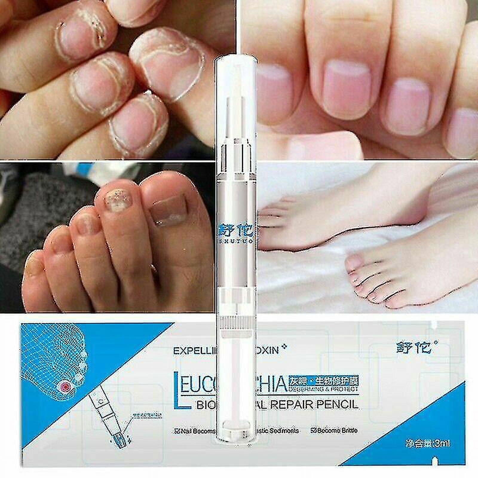 3ml Pro Anti Fungal Nail Treatment Repair Finger Toe Care Nail Fungus ...