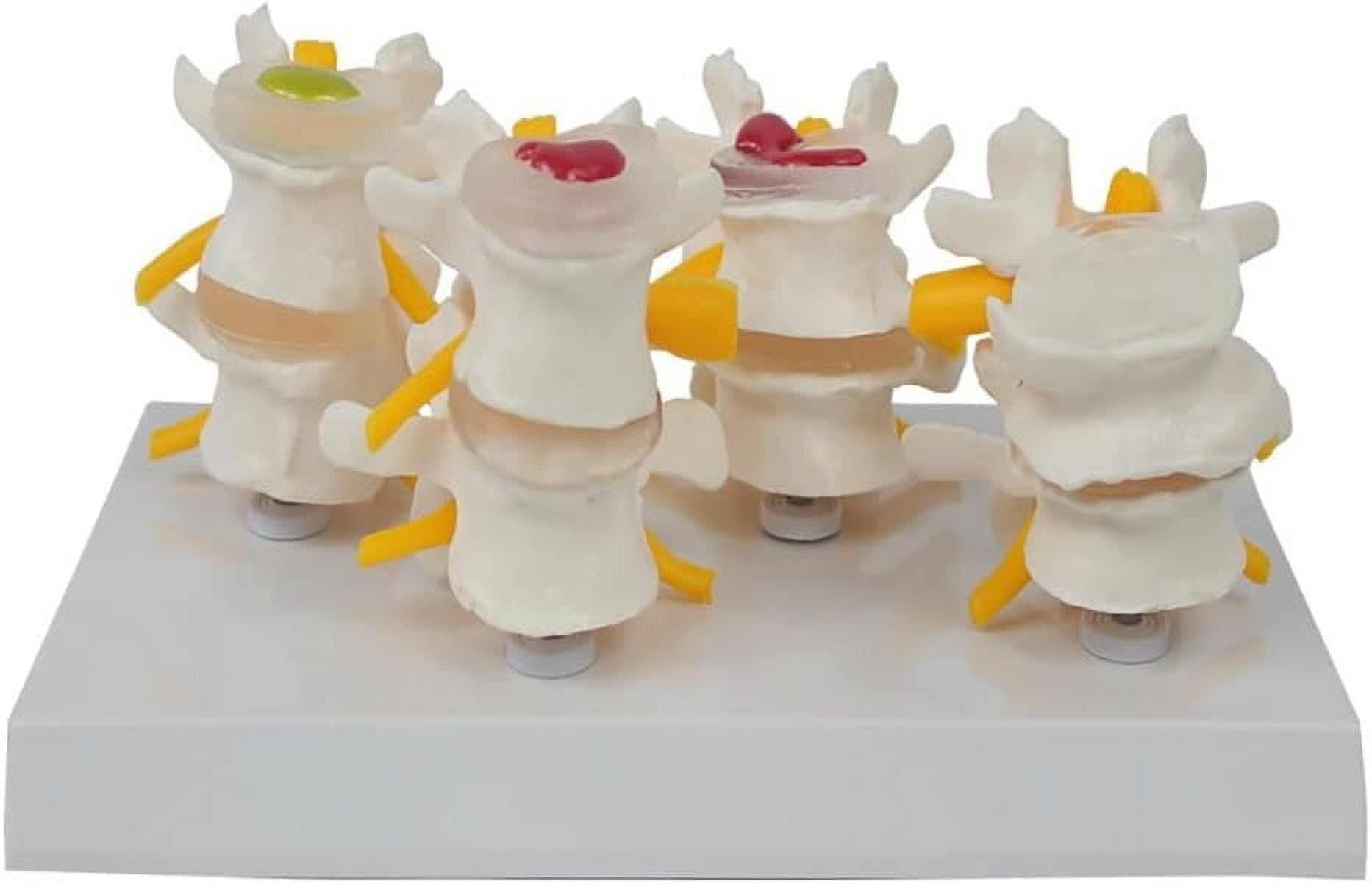 4 Stages Lumbar Spine lesions Comparative Model - Walmart.com