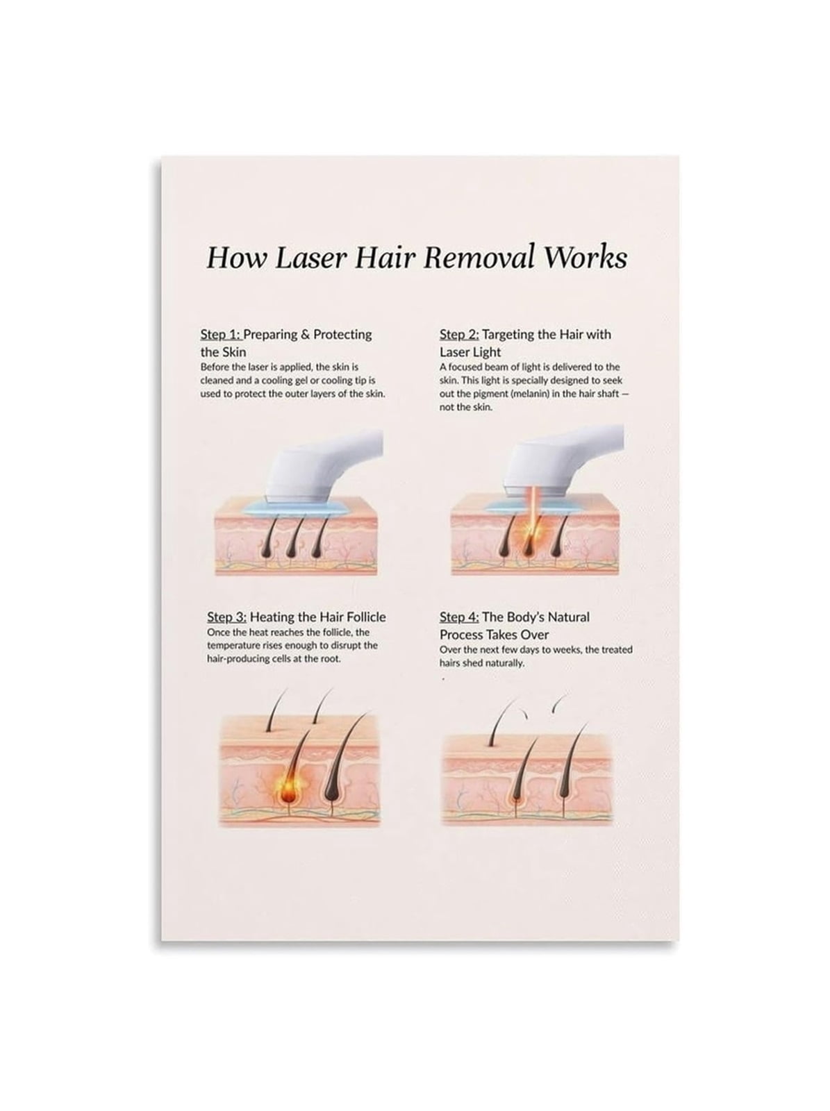 4 Step Hair Removal Treatment Guide Poster Visual Explanation How It ...