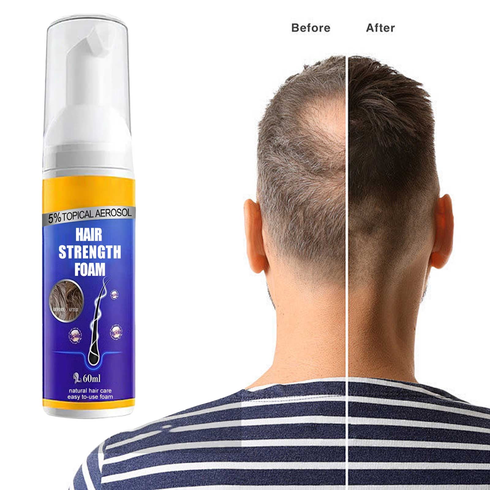 5% Foam Unscented For Men & Women Helps Stop Hair Thinning & Loss ...