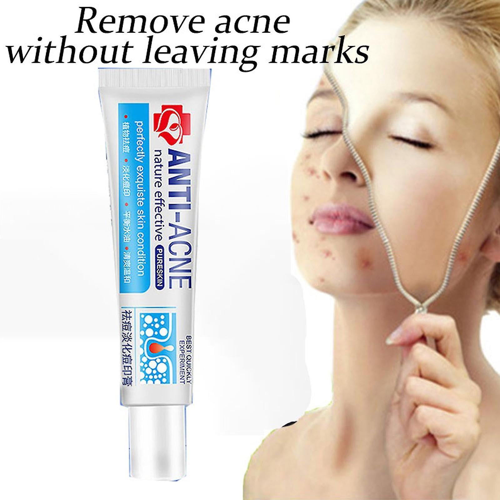 50% Off,remove Pimples Quickly Acne Gel Scar Remover Pimple Remover ...
