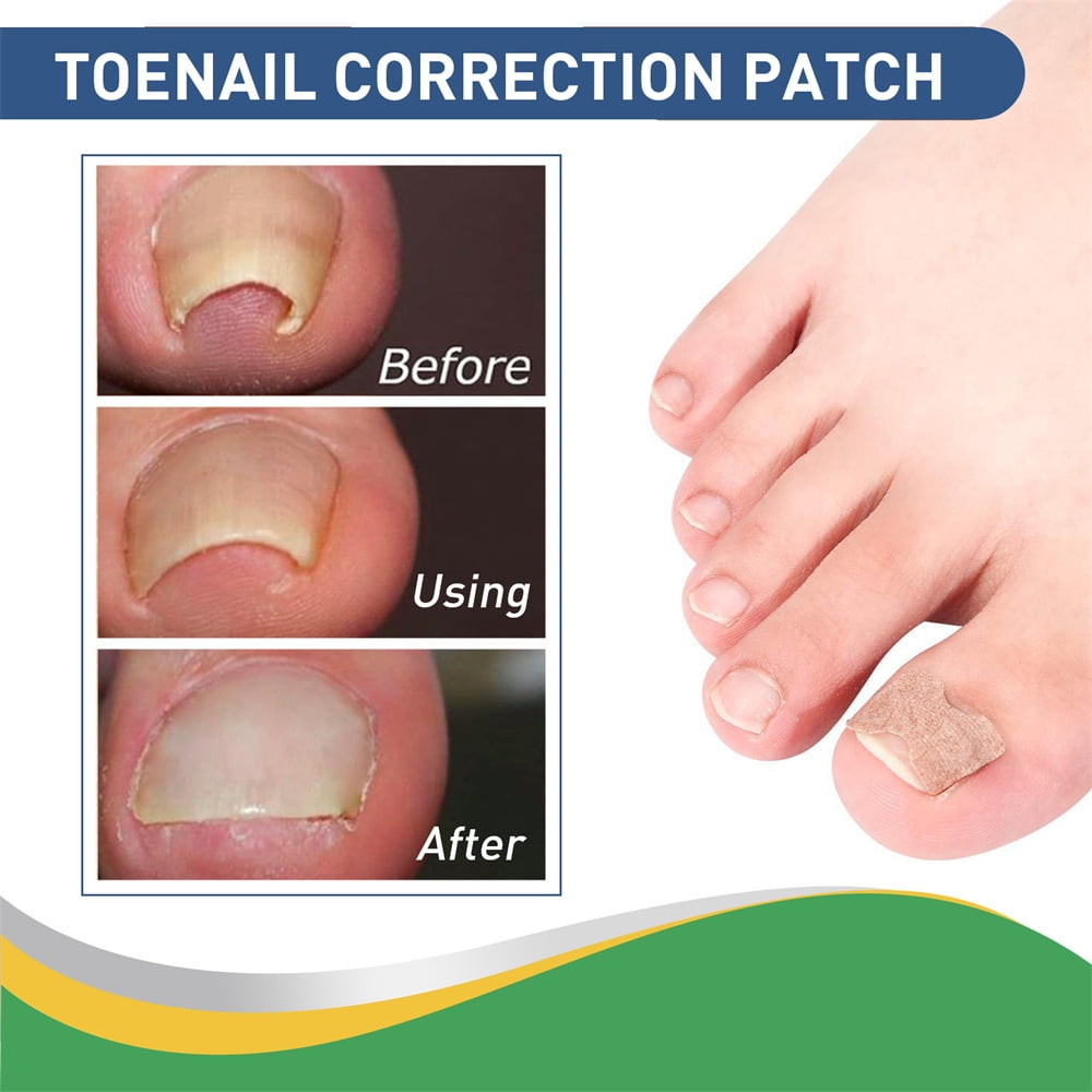 50pcs Ingrown Toenail Pain Stickers, Waterproof Paronychia Treatment ...