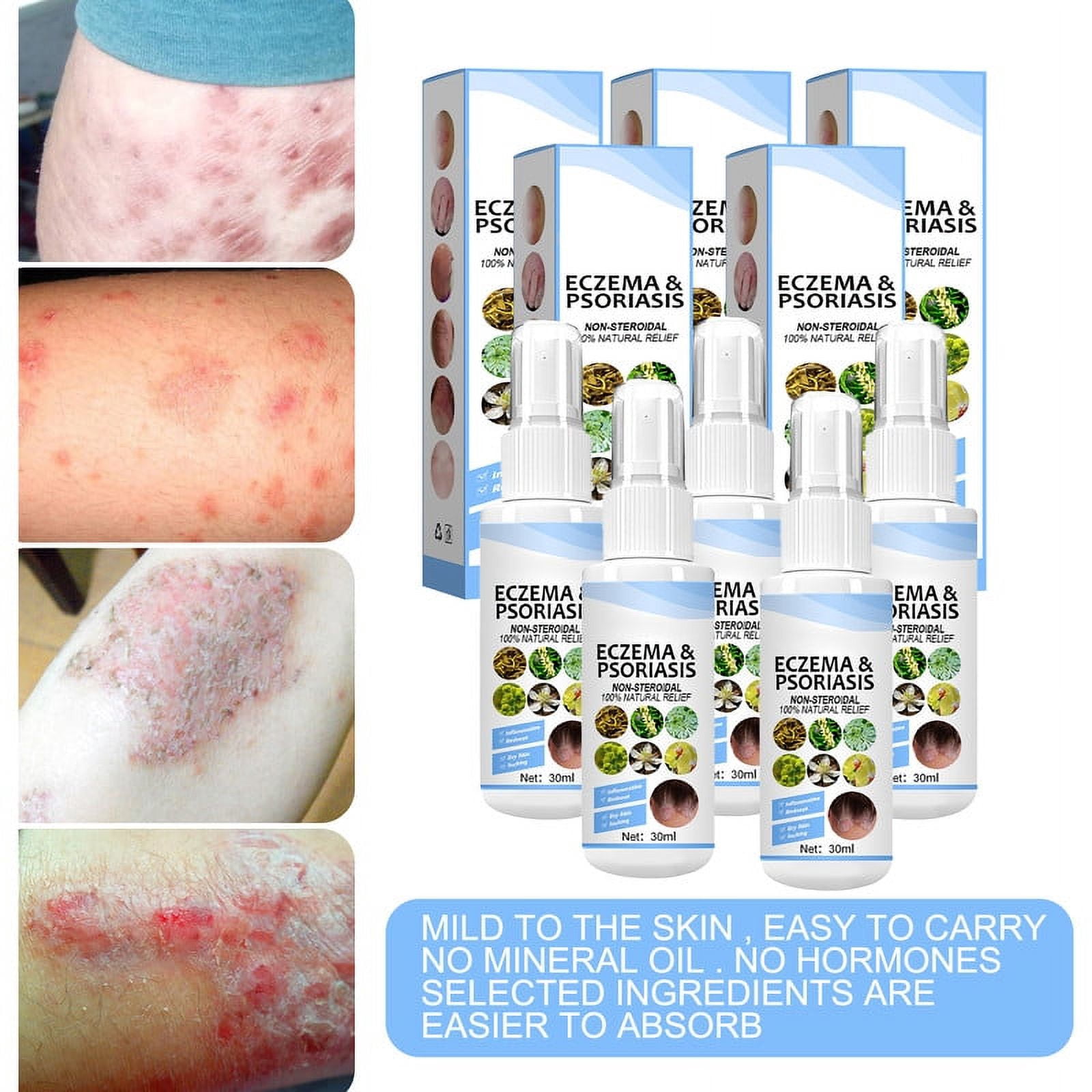 5PCS Anti Itch Spray &Antiseptic, Bacteriostatic Spray Body Itch ...