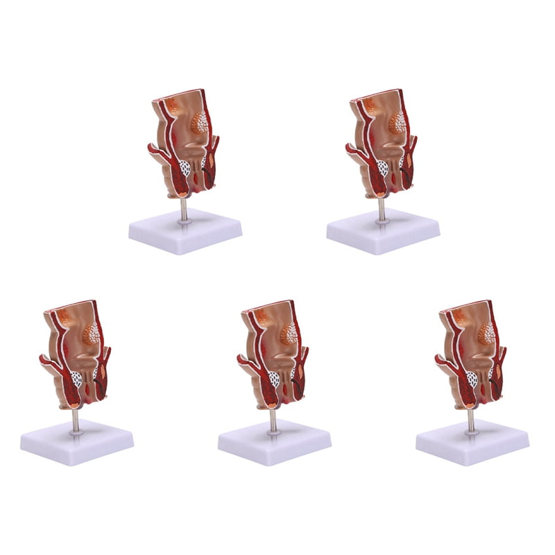 5X Anatomy Model Human Rectal Lesion Model Fistula Fistula Fissure ...