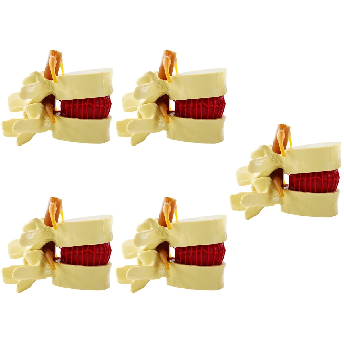 5pcs Human Lumbar Disc Herniation Model Lumbar Vertebrae Degenerative ...