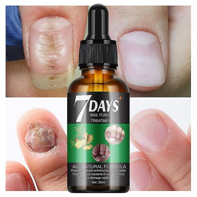 7 Days Nail Fungus Treatment, 7 Days Nail Growth And Strengthening Serum Nail, Nail Repair ...