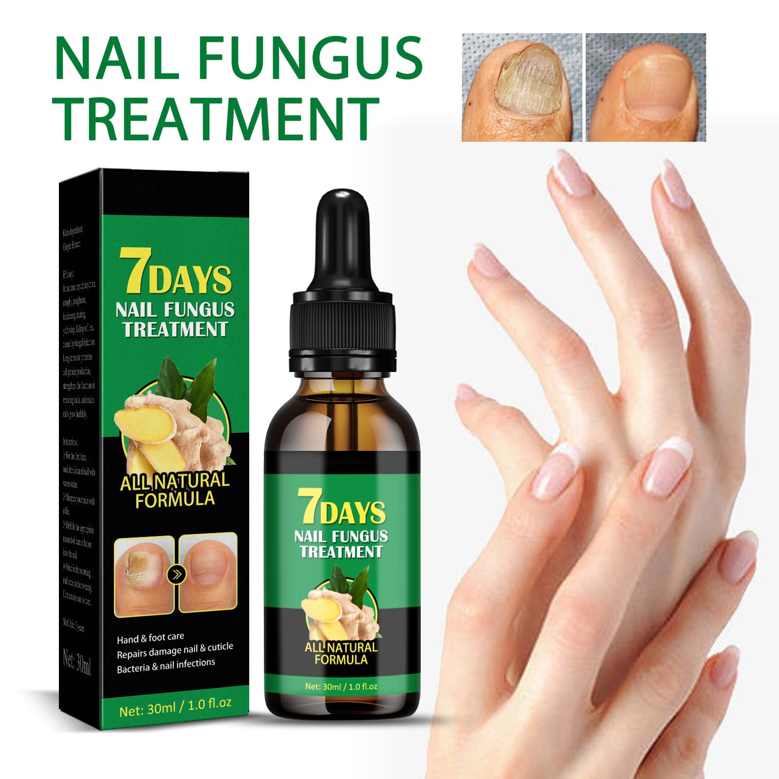 7 Days Nail Fungus Treatment Essence Serum, Nail Fungus Treatment For Toenail, Ginger Nail ...