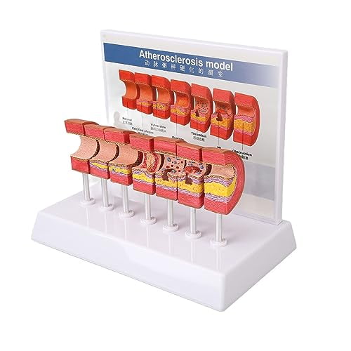 7PCS Artery Anatomy Model, Anatomical Vessel Atherosclerosis Thrombus ...