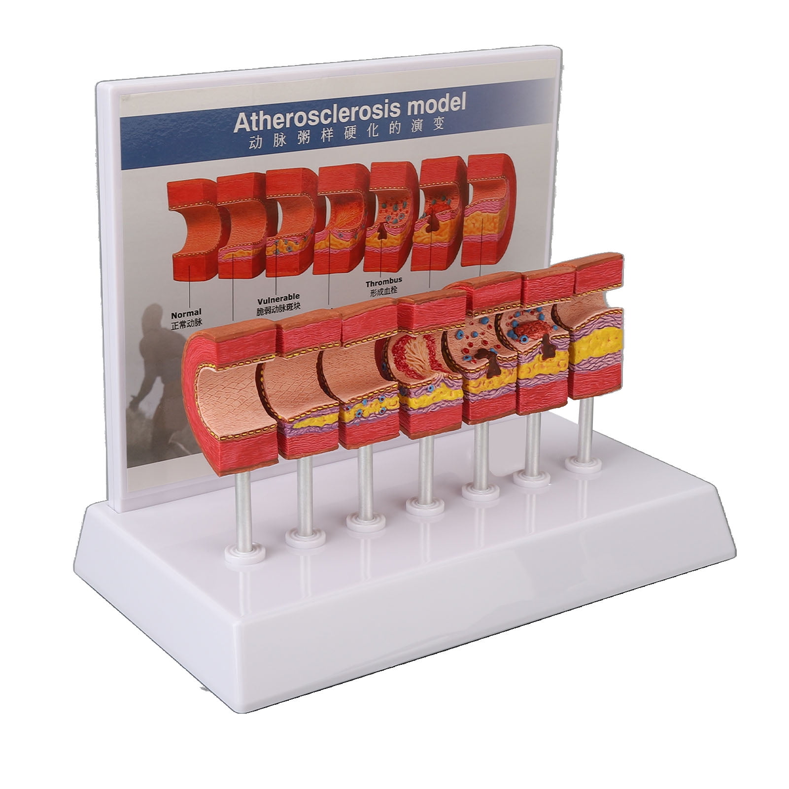 7PCS Artery Anatomy Model Anatomical Vessel Atherosclerosis Thrombus ...