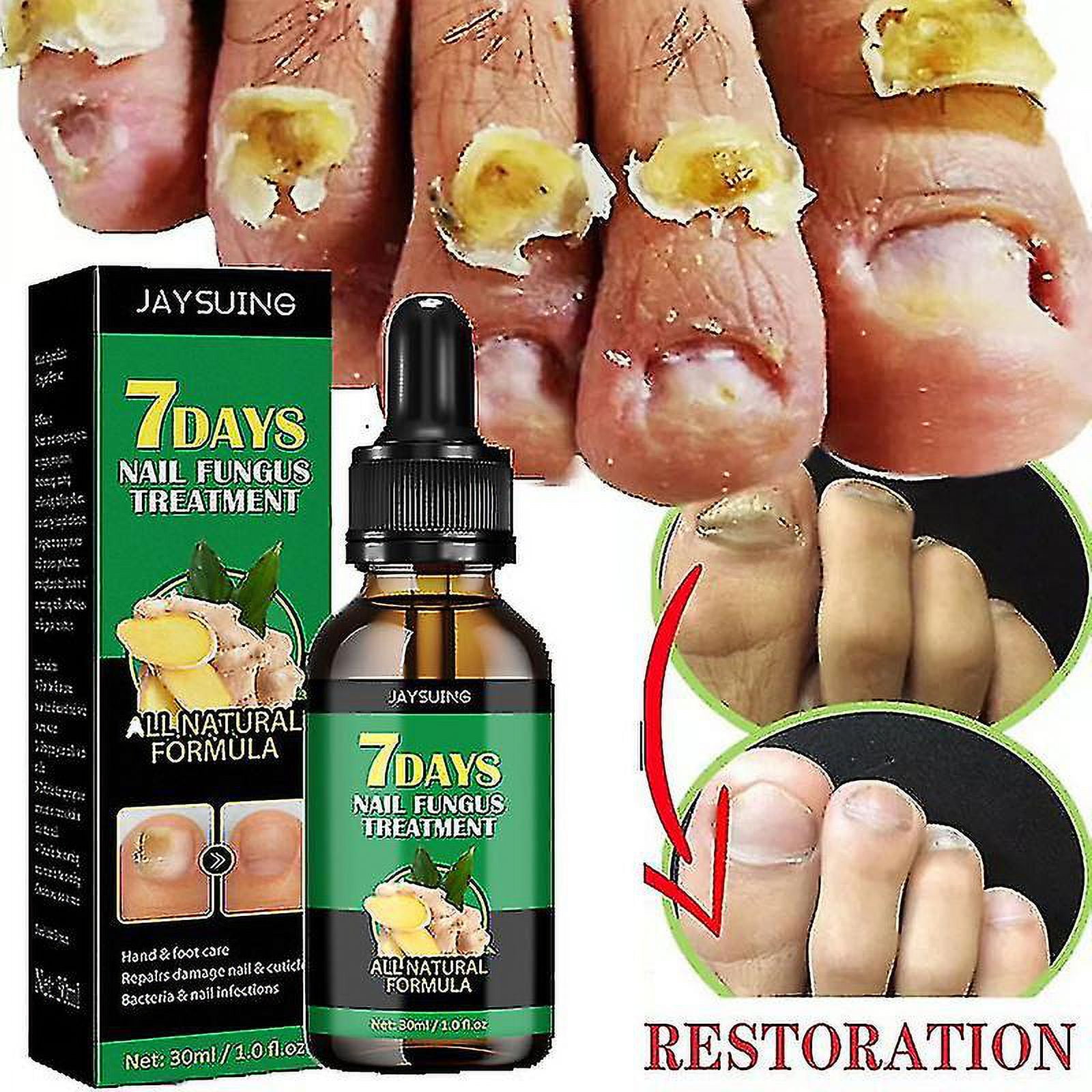 7days Nail Fungus Treatment Essence Serum Anti-infection Onychomycosis ...