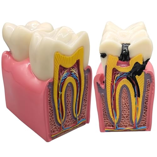 8 Times Dental Caries Teeth Model, Dental Education Demonstration Tooth ...