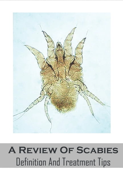 A Review Of Scabies_ Definition And Treatment Tips : Scabies Treatment ...