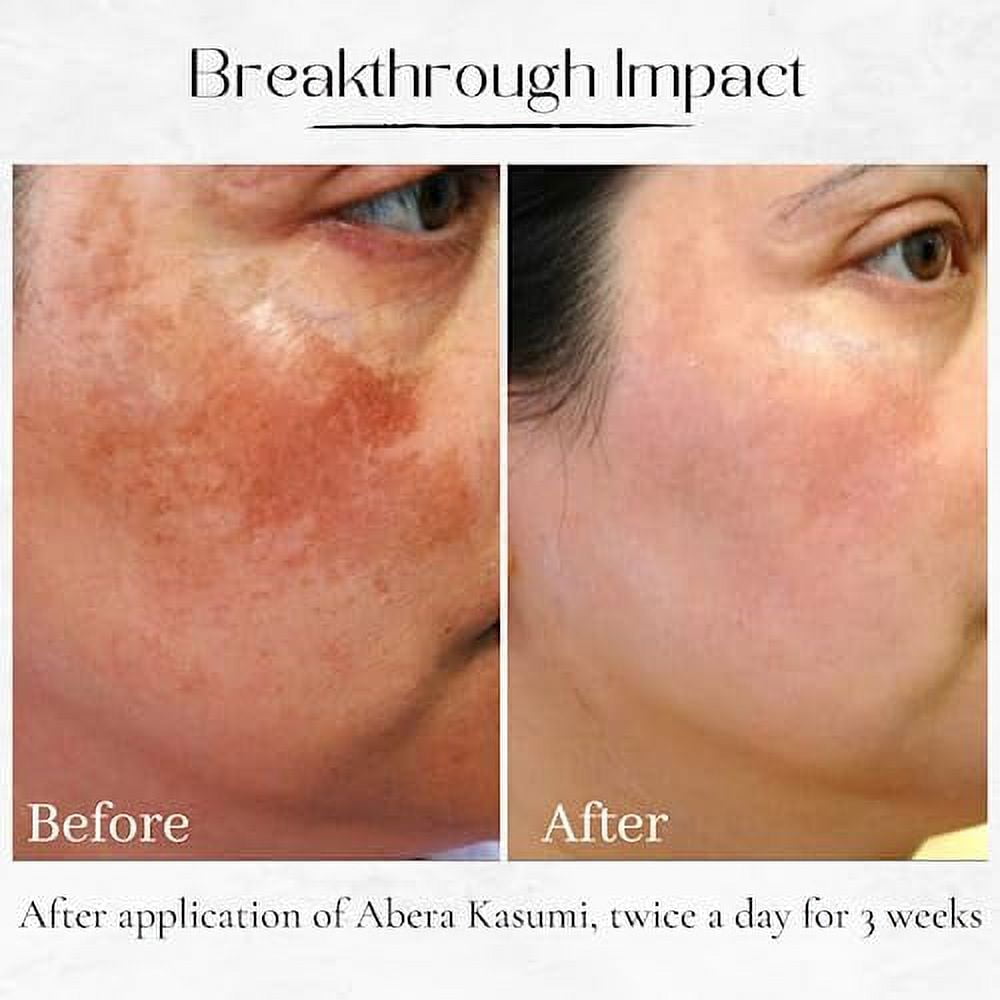 Melasma Treatment