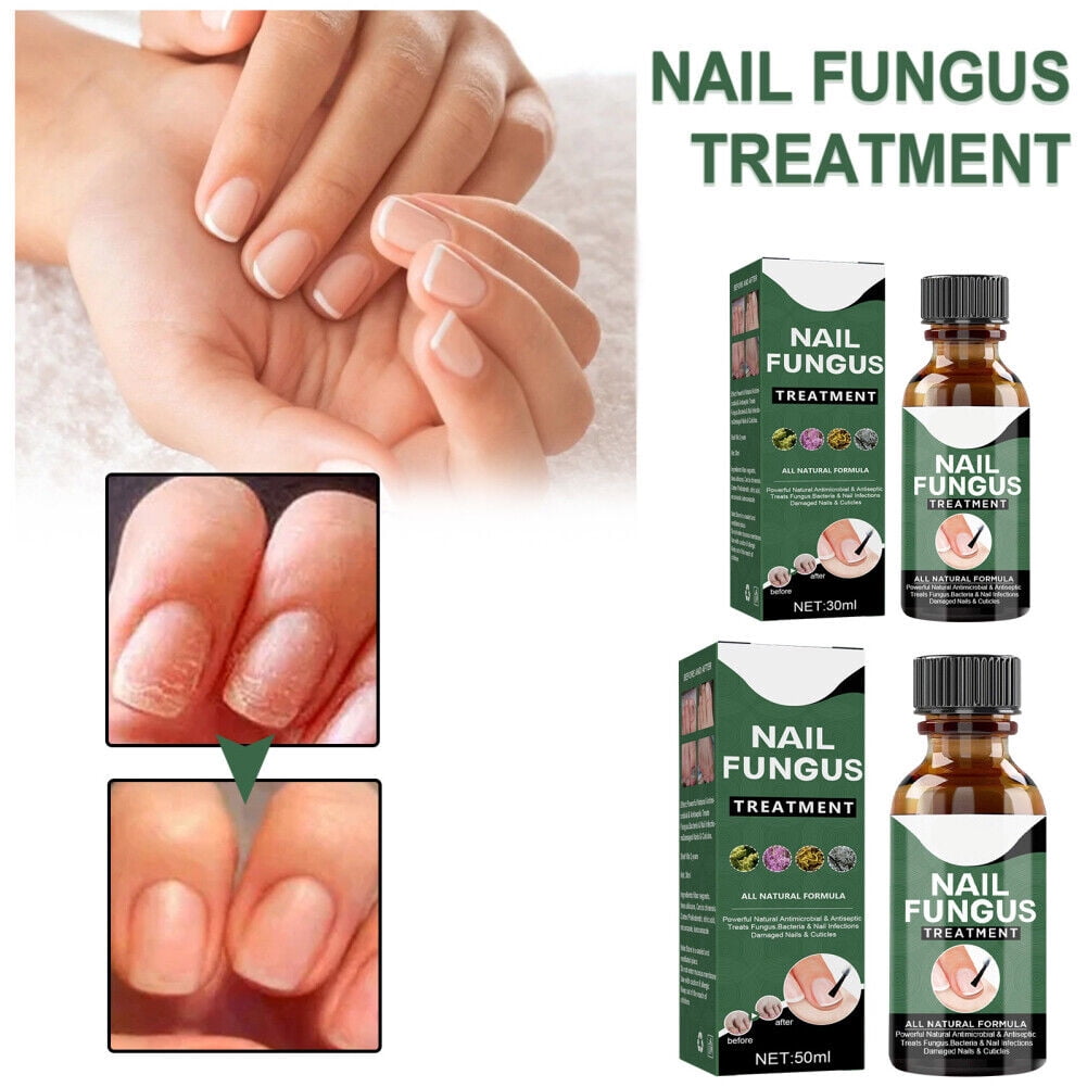 ANTI FUNGAL TREATMENT EXTRA STRENGTH TOENAIL FUNGUS FUNGI XS NAIL ...