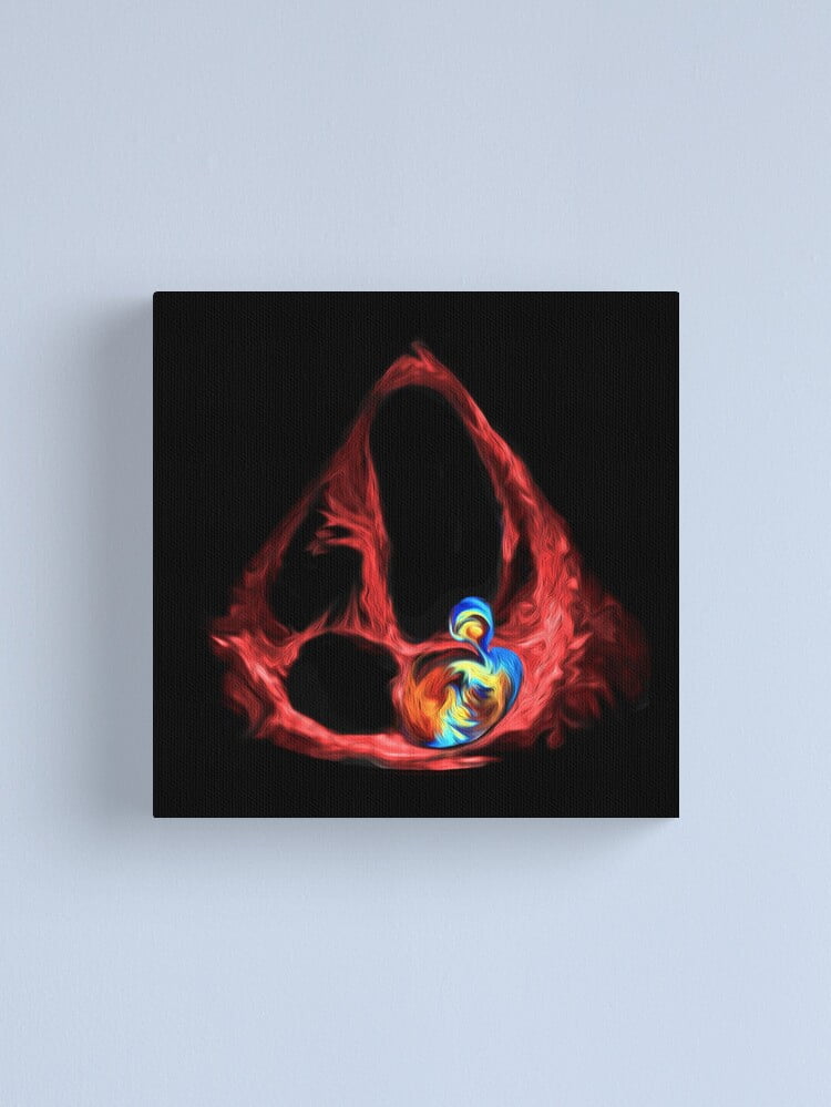 Aaroca Mitral regurgitation PISA Canvas Print (Unframed) Classic Decoration for Office Modern ...