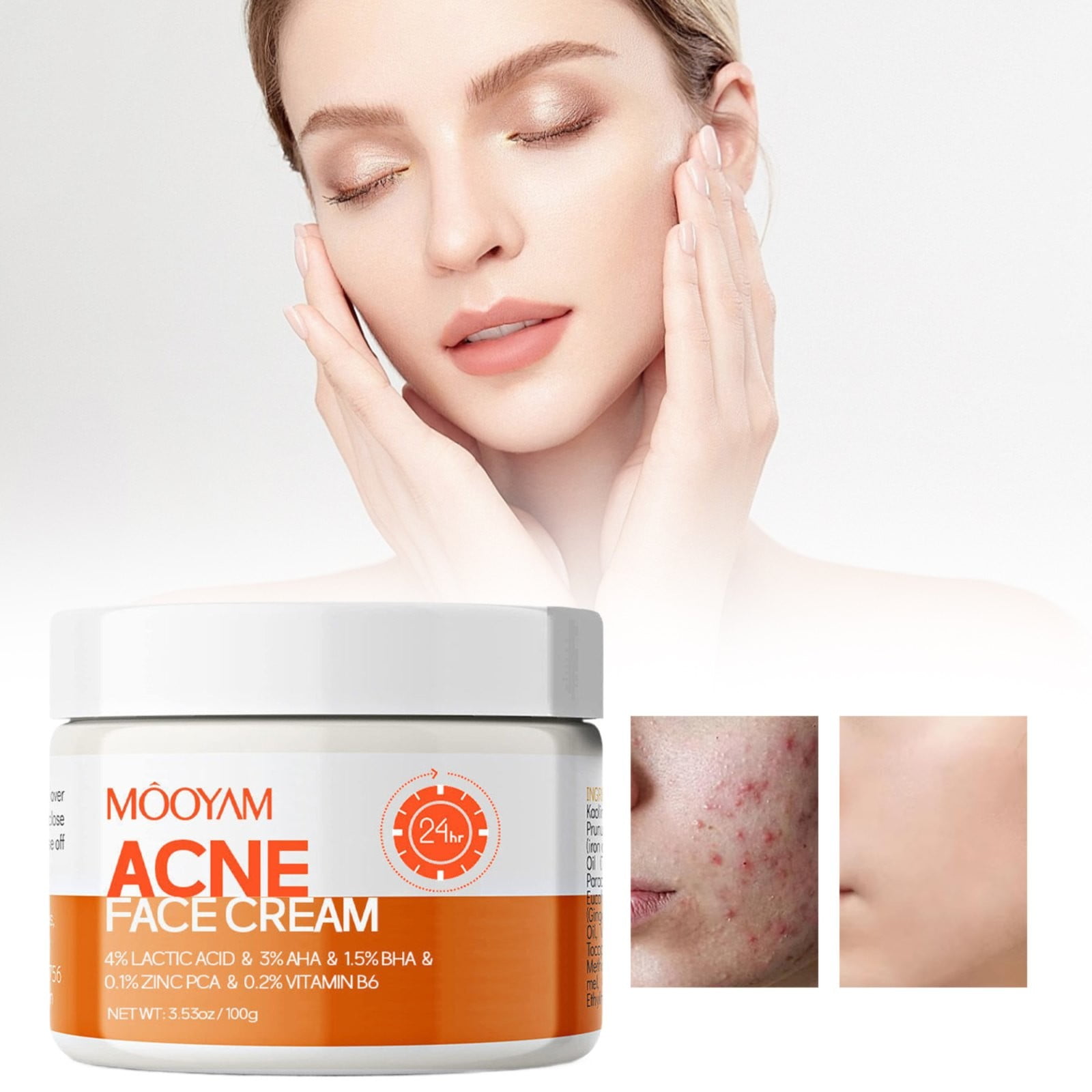 Acne Cream for Face & Body – Effective Pimple Reducer for Back ...