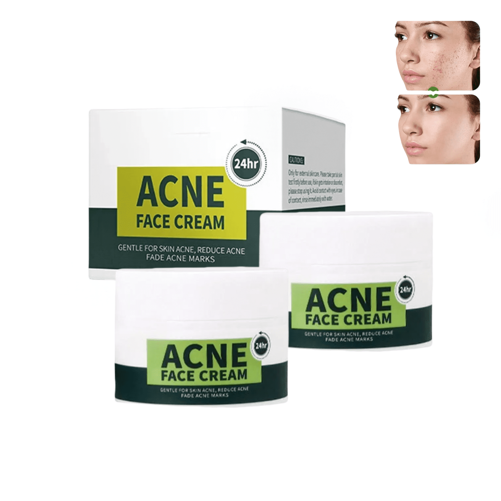 Acne Cream Pimple Cream for Face, Oil Control Pimple Remover Cream Get ...