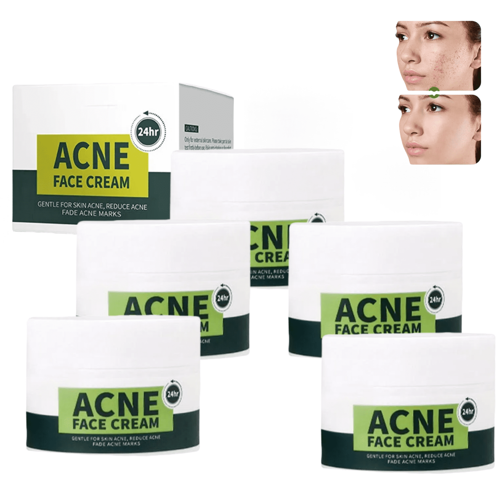 Acne Cream Pimple Cream for Face, Oil Control Pimple Remover Cream Get ...