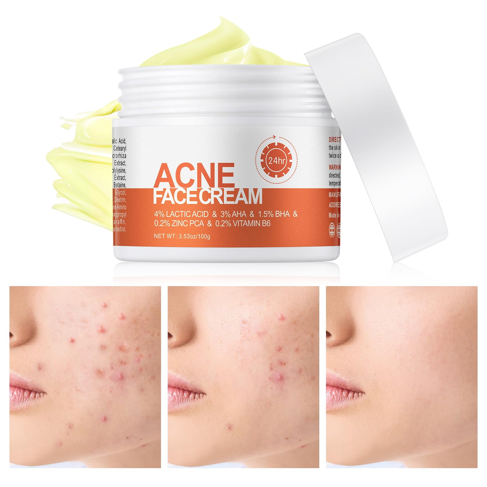 Acne Cream, Salicylic Acid BCA3 Cystic Acne Treatment For Back Butt ...