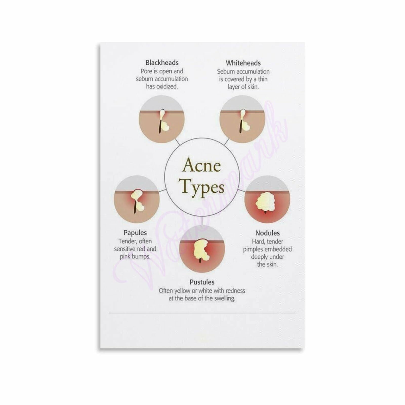 Acne Face Map Beauty Clinic Skin Analysis Posters3 Canvas Painting Wall ...