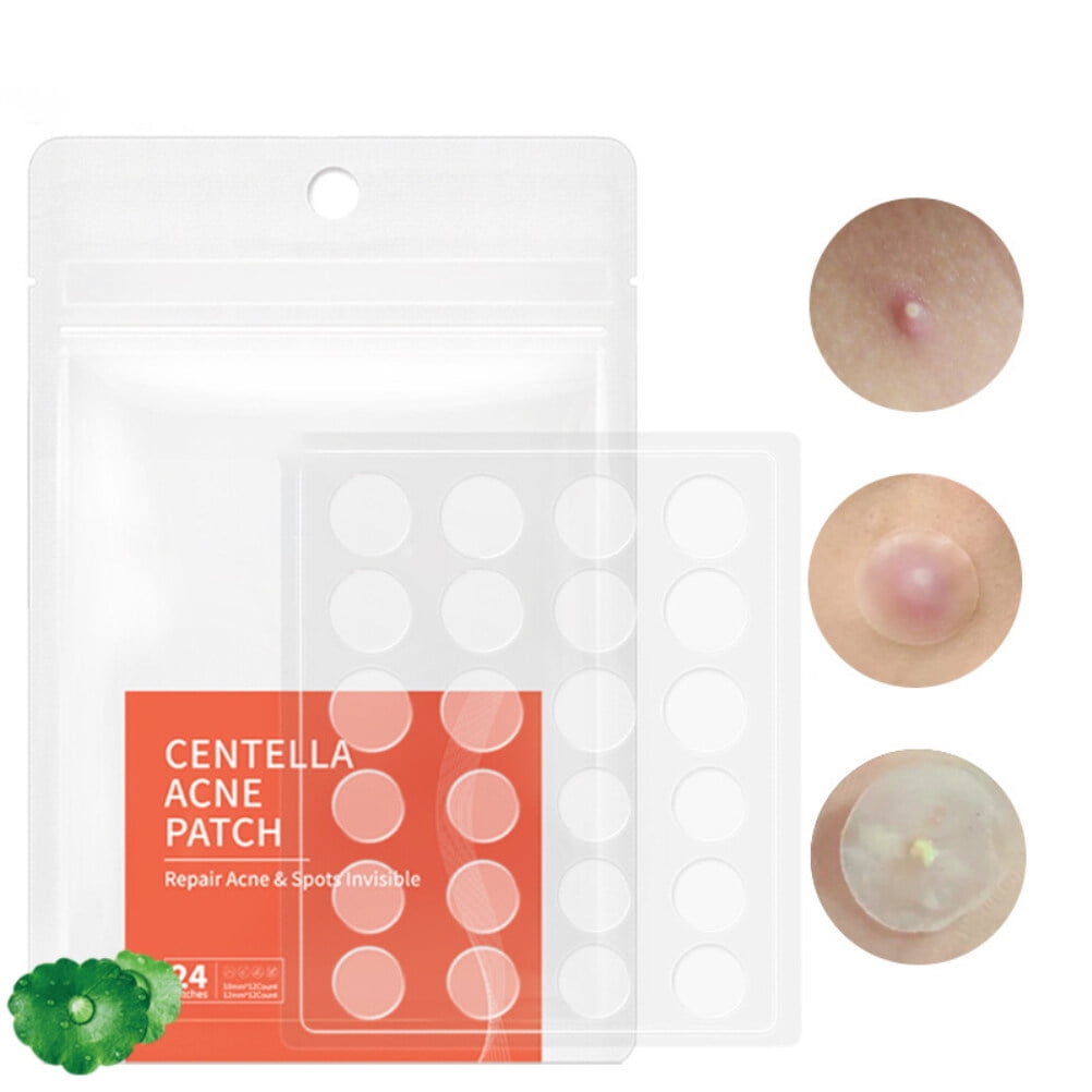 Acne Patches Hydrocolloid Acne Pimple Patches for Emergency Care and ...
