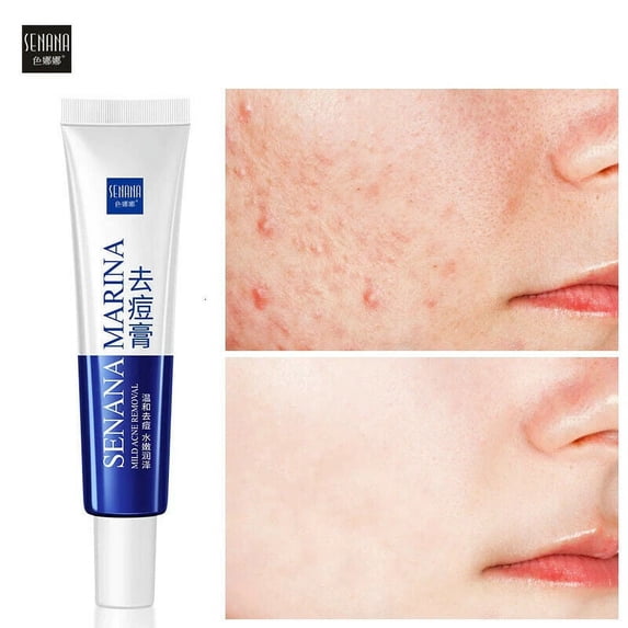 Acne Removal Nicotinamide Cream Aloe Vera Oil Control Shrink Pores ...
