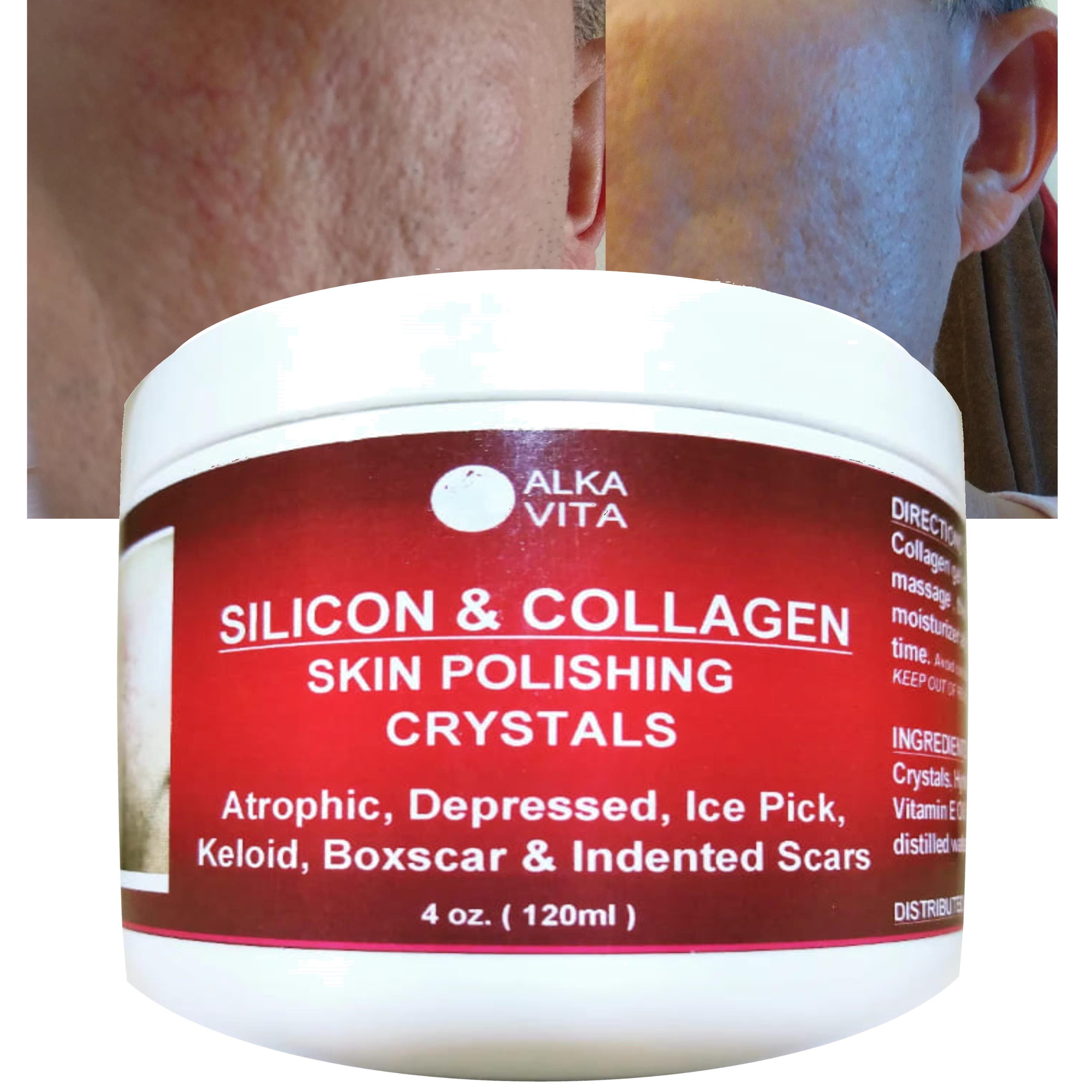 Collagen For Acne Scars
