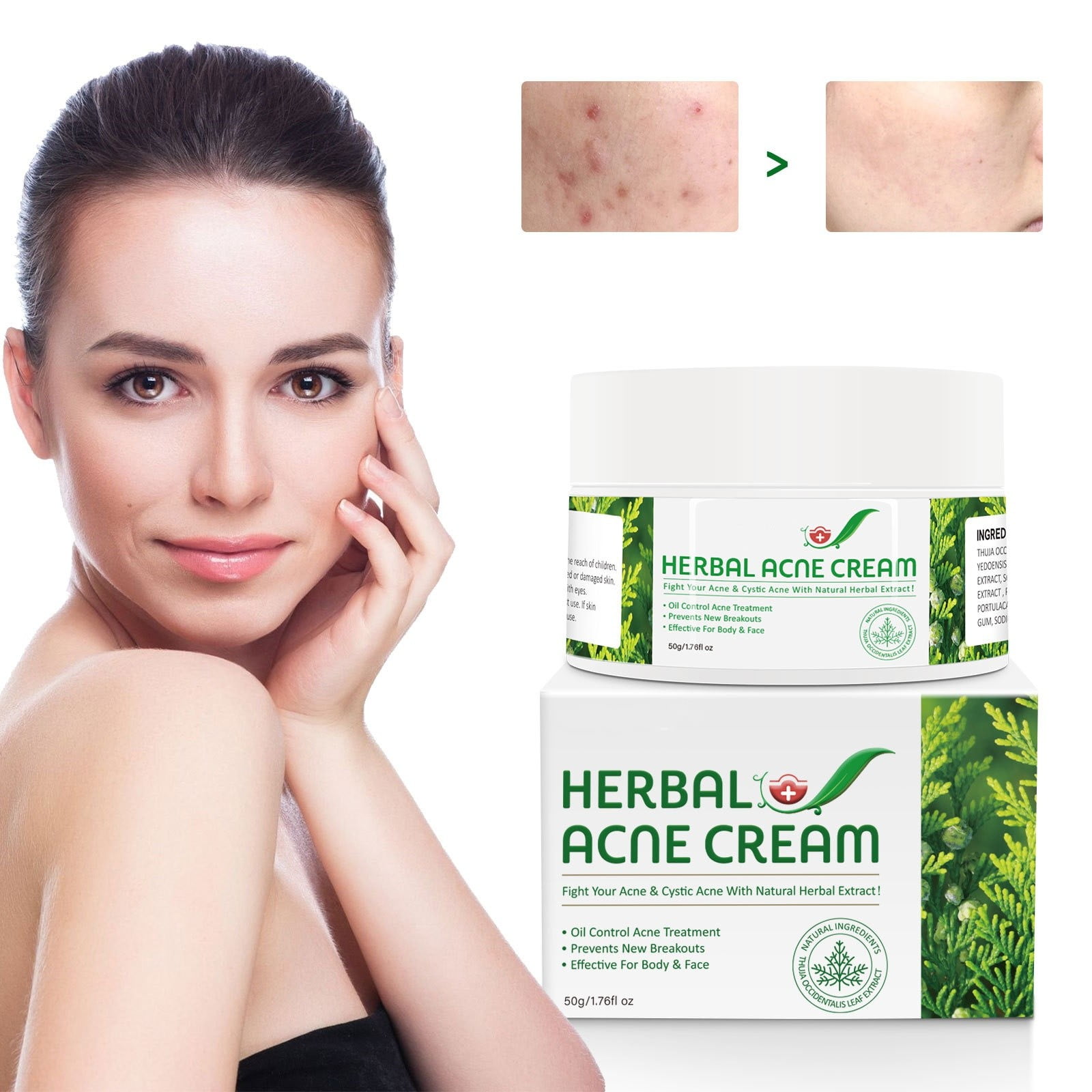 Acne cream - Dark Spot Corrector for Men & Women - Fades Acne Marks ...