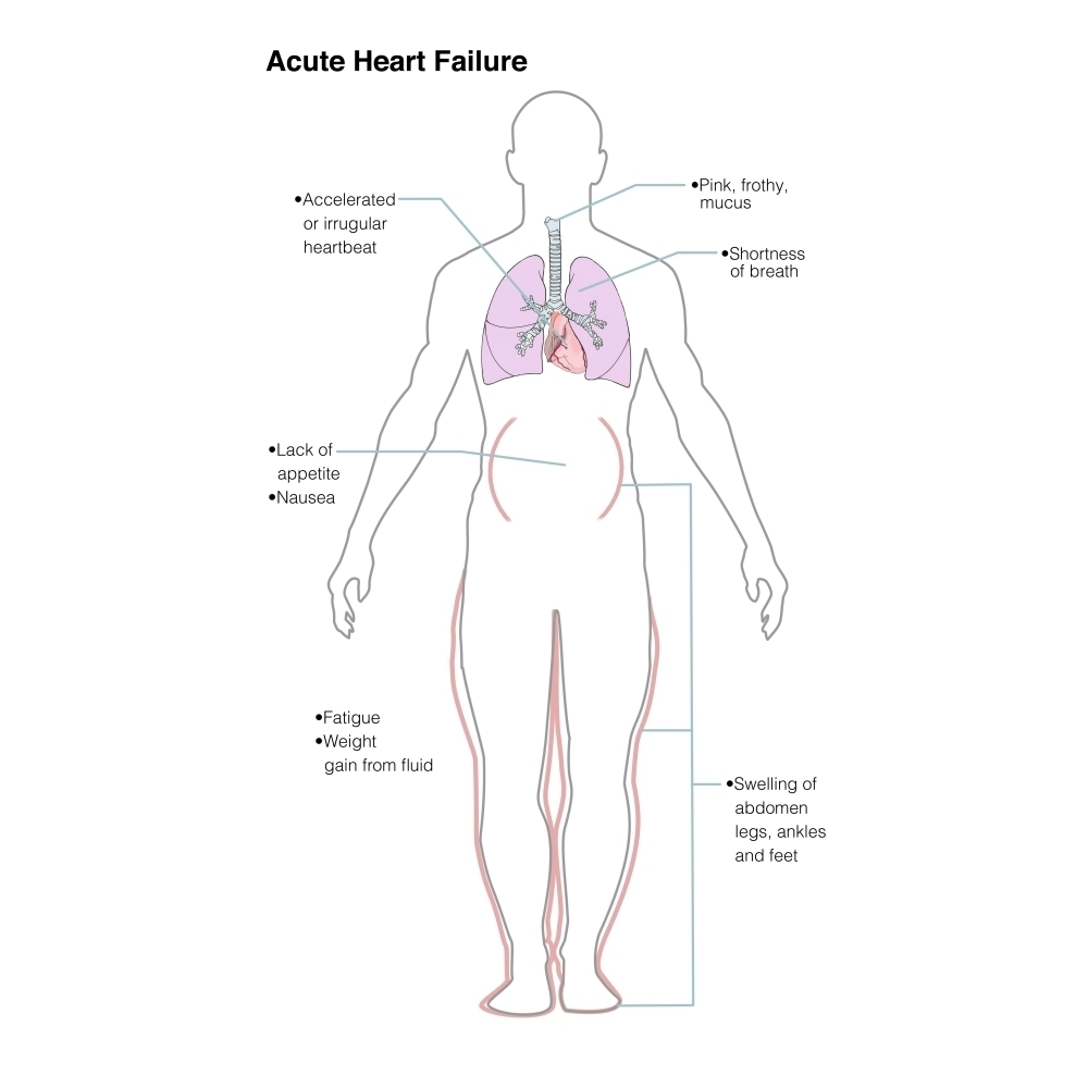 Acute Heart Failure Poster Print by Spencer Sutton/Science Source (18 x 24) - Walmart.com