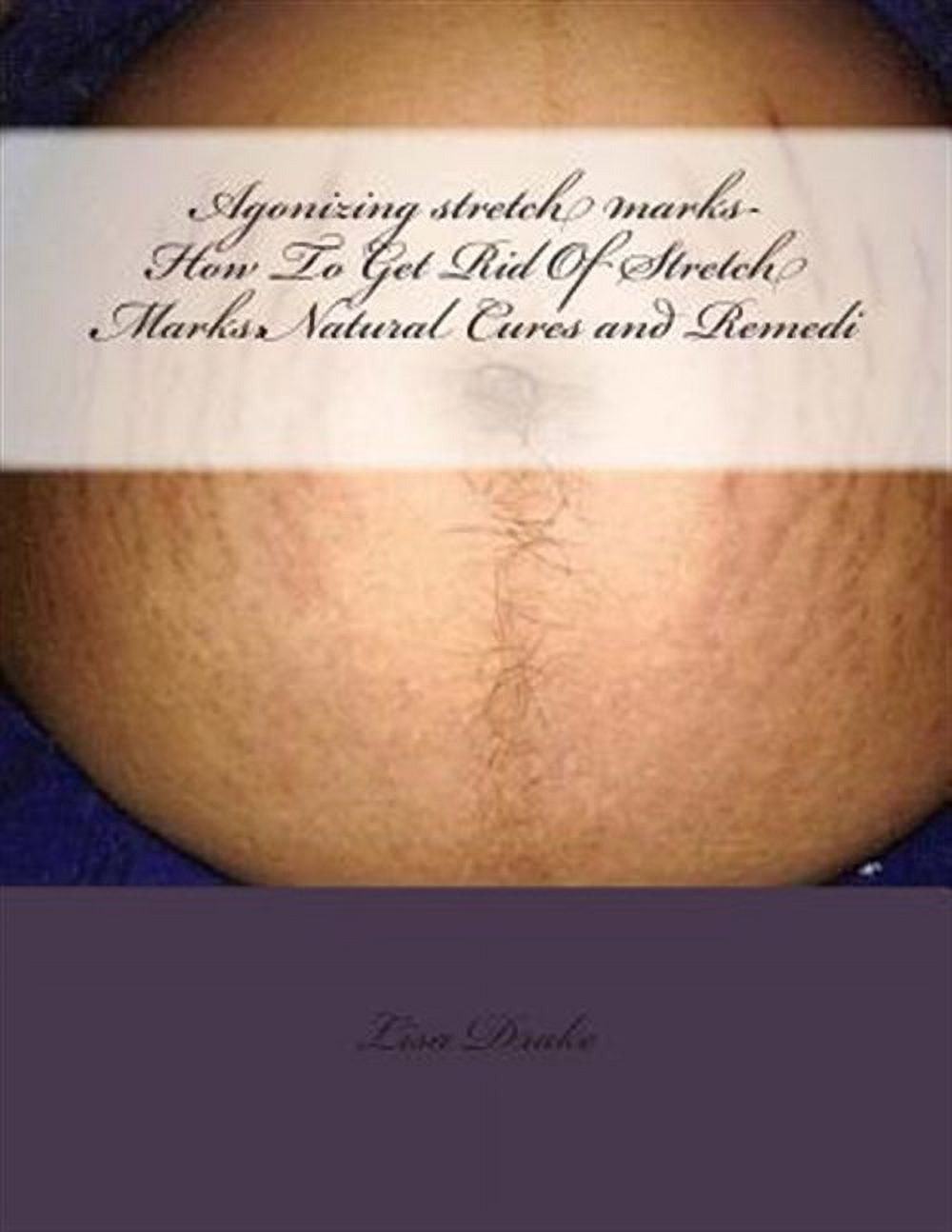 Agonizing Stretch Marks-How to Get Rid of Stretch Marks: Natural Cures ...