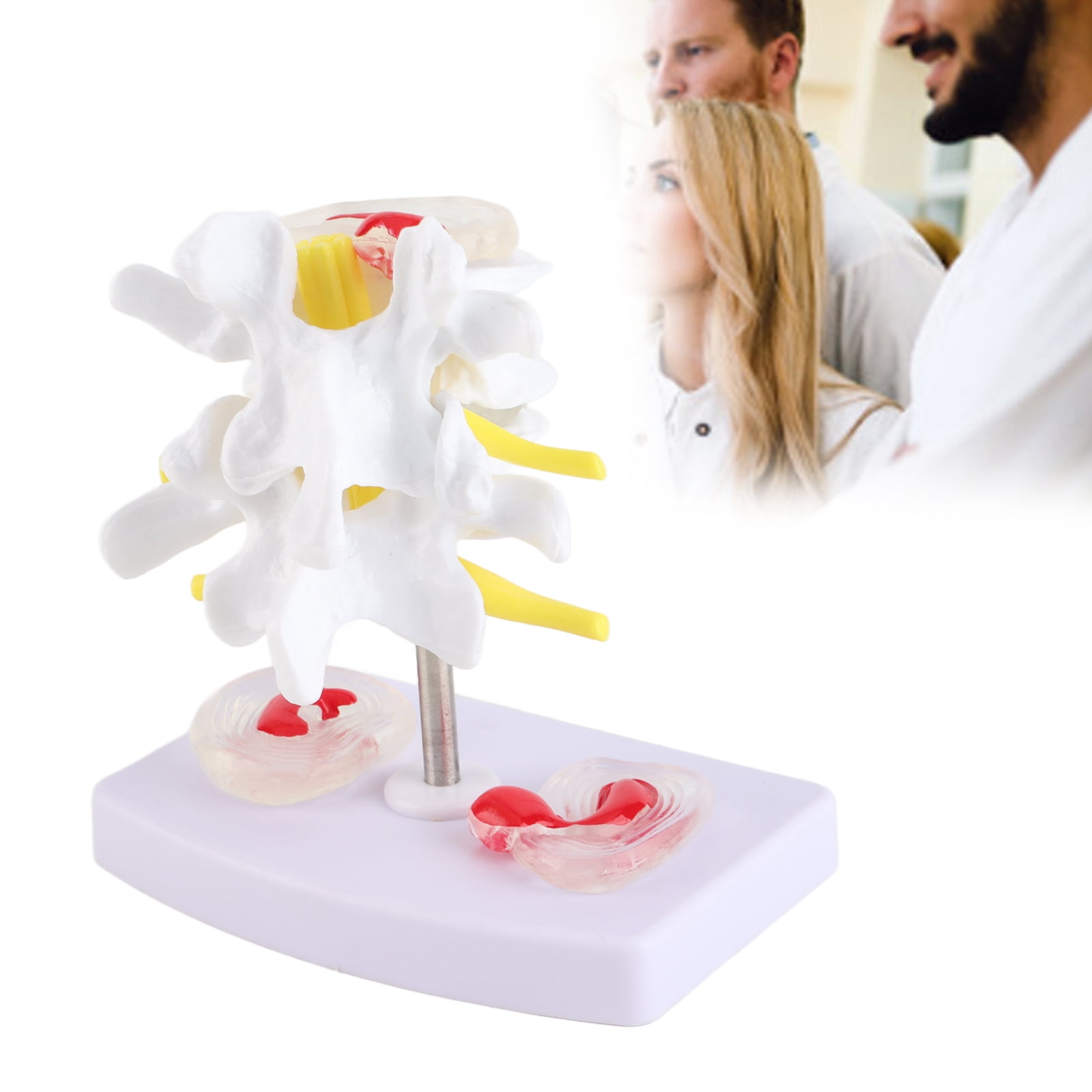 Anatomical Lumbar Disc Herniation Demonstration Model Human Spine School Training Supplies ...